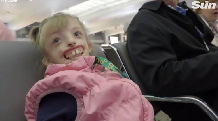 First smile in life: 6-year-old Russian woman born without lips and ...